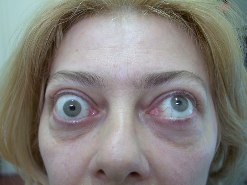 Exoftalmia; Proptose