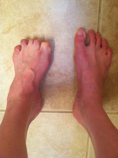 It is Not Brain Surgery!: Day 27 - Dystonia and Beautiful Feet