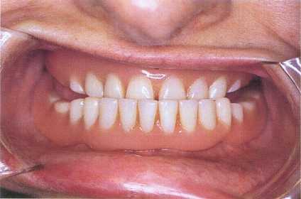 Dentistry lectures for MFDS/MJDF/NBDE/ORE: A Note On Denture Coping ...