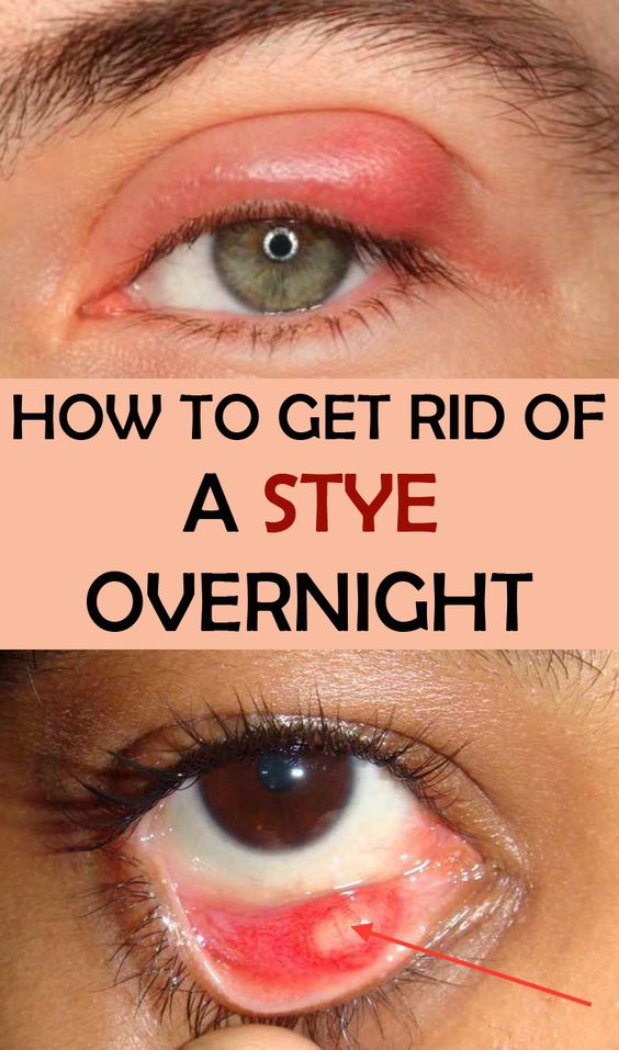 How To Get Rid Of A Stye Overnight Wellness Click how-to-get-rid-of-a-stye-overnight-wellness-click