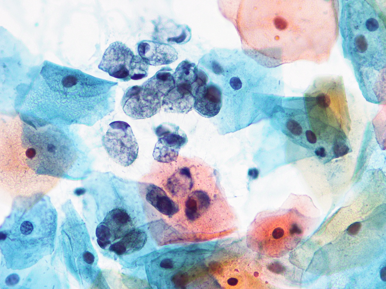 Enfermería: mujer y ERNIA: La citología vaginal puede tener los días ...