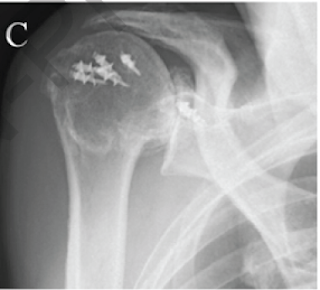 Shoulder Arthritis / Joint Replacement : Superior capsular ...