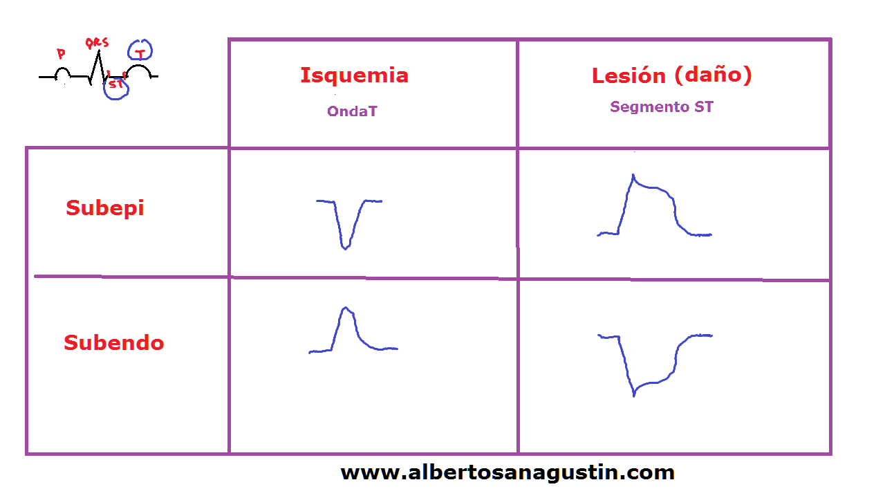 Isquemia y lesión en el electrocardiograma (tabla mnemotécnica) | Dr ...