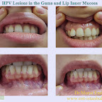 Nose Tip Cleaning After Open Technique Rhinoplasty