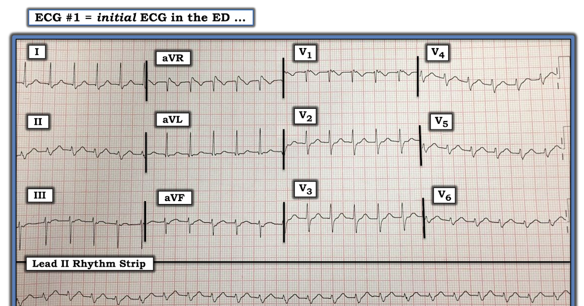 ECG Interpretation: ECG Blog #240 (55) — What Kind of Regular SVT?