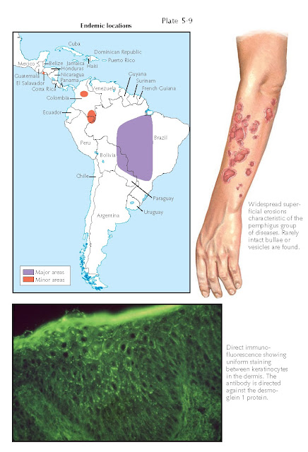 PEMPHIGUS FOLIACEUS - pediagenosis