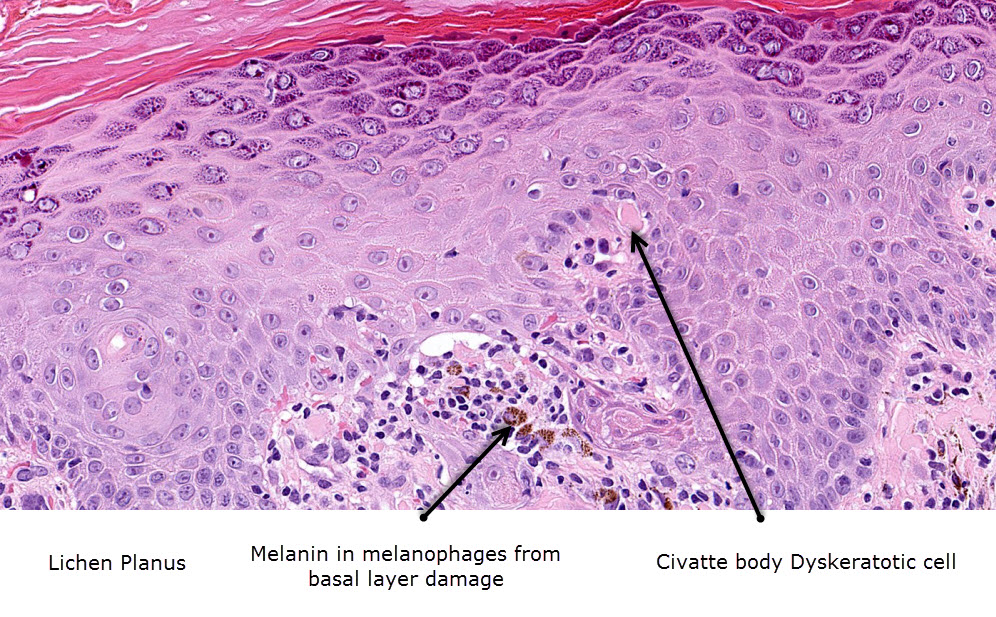 DermPath Diagnosis: Lichenoid infiltrate