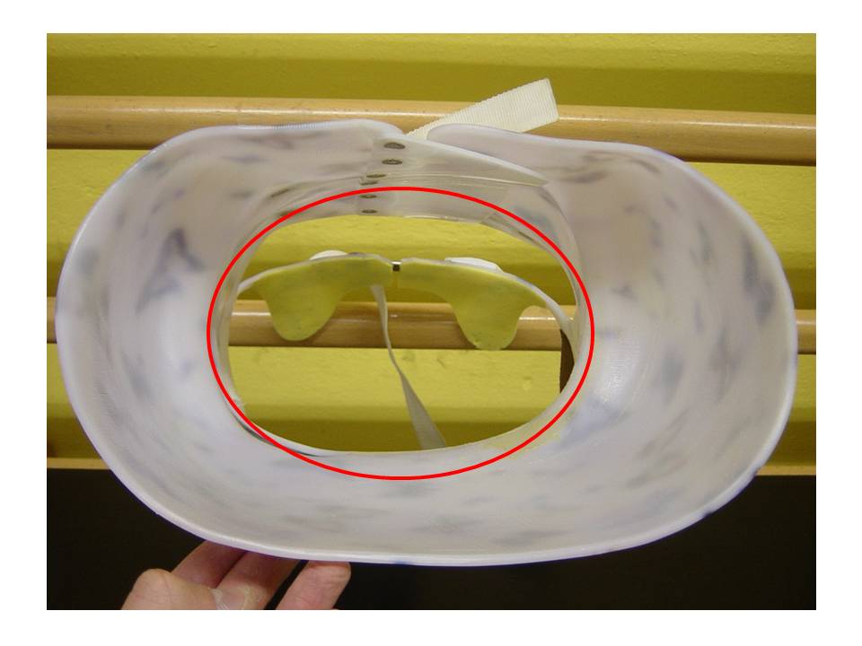 Despre corsetul Cheneau :: Corset scolioza / scoliosis braces