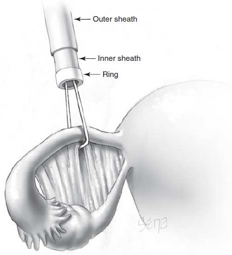 Laparoscopic Tubal Occlusion Case File