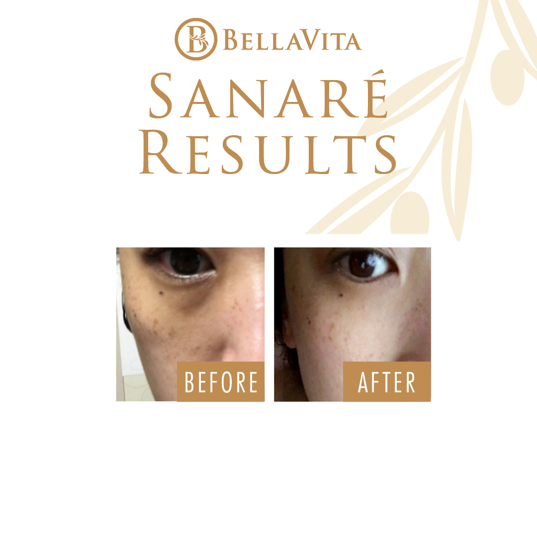 AMAZING results from our new product SANARÉ