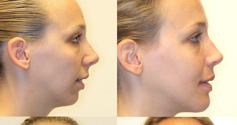 Esther's Kaakoperatie: Foto's