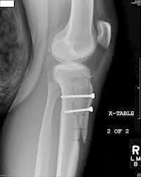 Paraphernalia: pin in leg