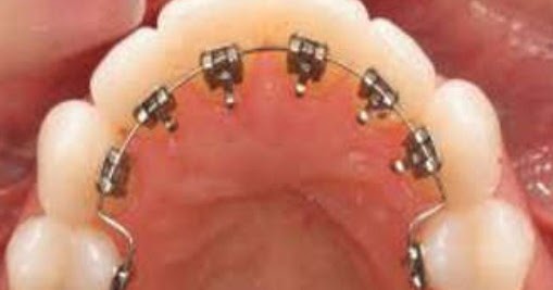 Cara Memilih Behel Yang Bagus, Baik dan Aman | IdiAccati