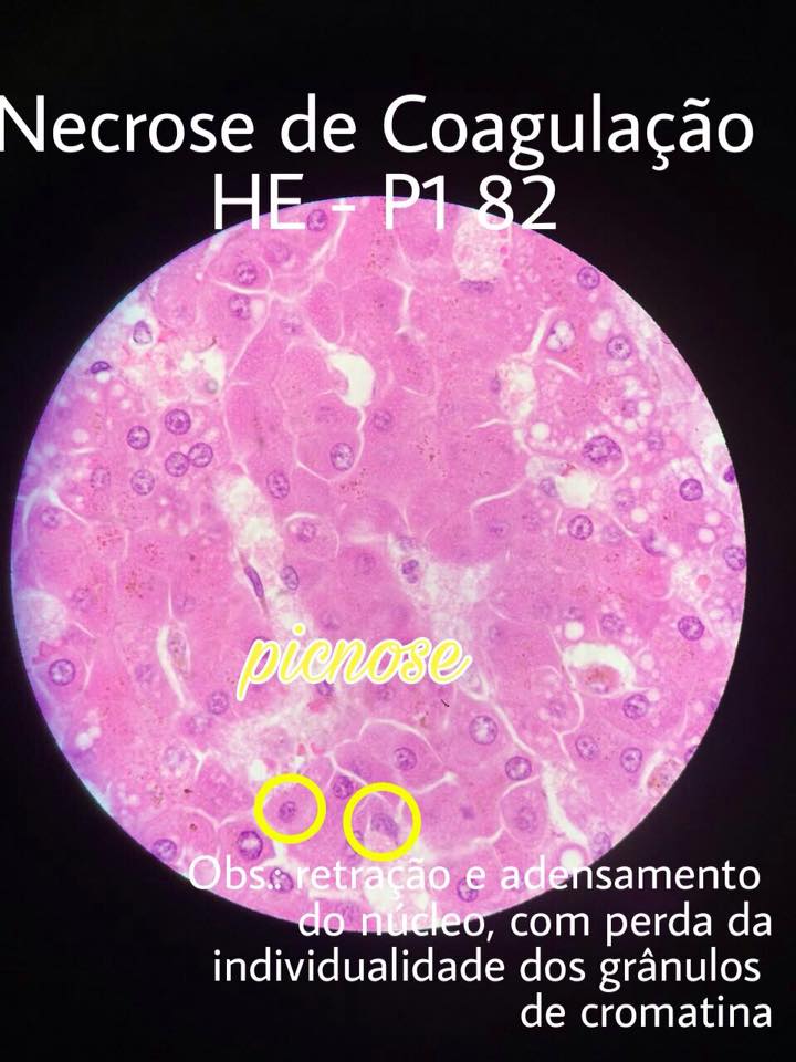 HISTOLOGIA90: TIPOS DE NECROSE