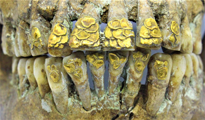 Bolinao Skull with Gold Teeth Ornamentation | Filipinos Centuries-old ...