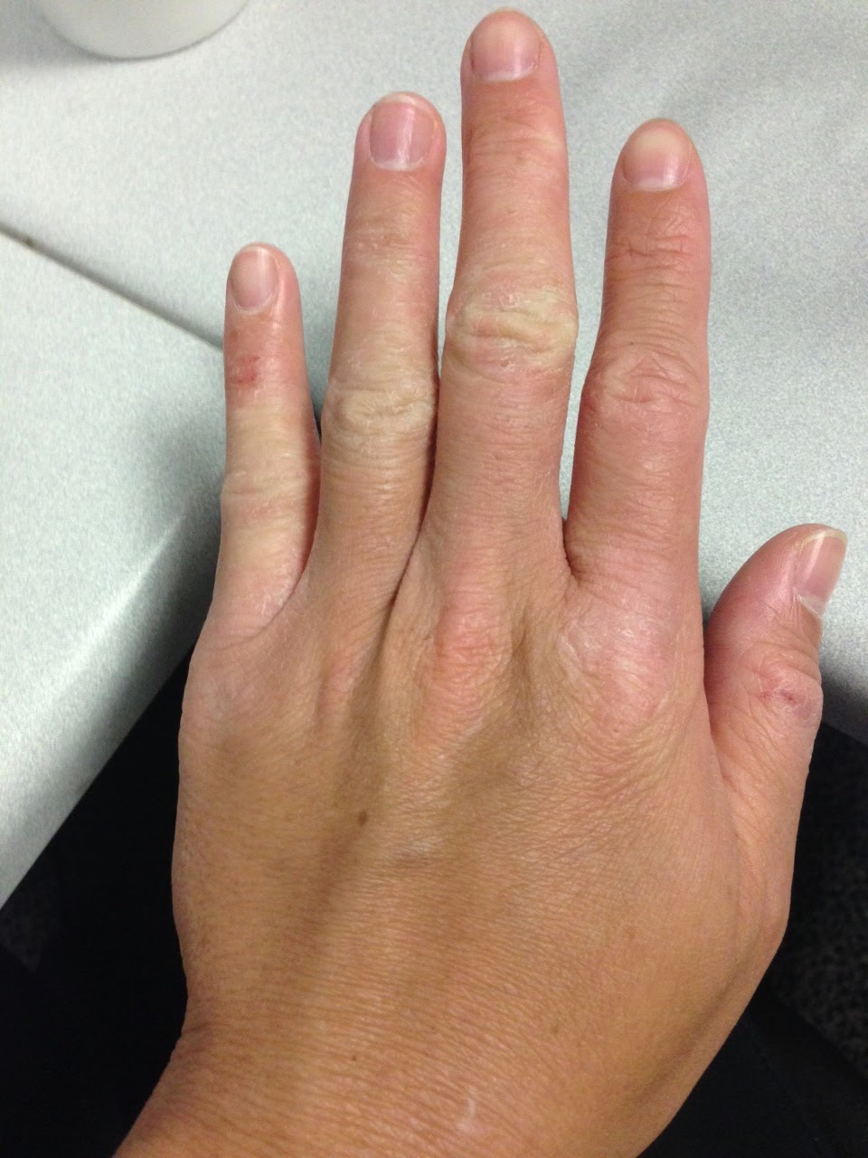 My journey to healthy skin: VIRAL: My skin caught a cold, then gave it ...