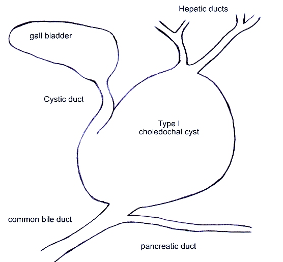 ABC Radiology Blog: Todani Classification Of Bile Duct Cysts