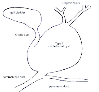 ABC Radiology Blog: Todani Classification Of Bile Duct Cysts