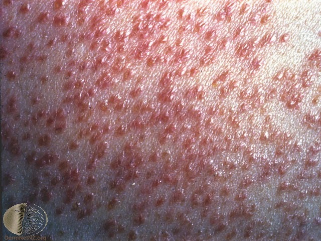 Blog del Internista: Resumenes de Dermatología - Enfermedades ...