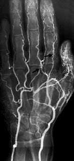 Artériopathies iatrogènes et toxiquesencymedi