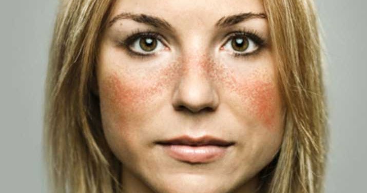 Gejala dan Penyebab Penyakit Lupus | Health and Hope