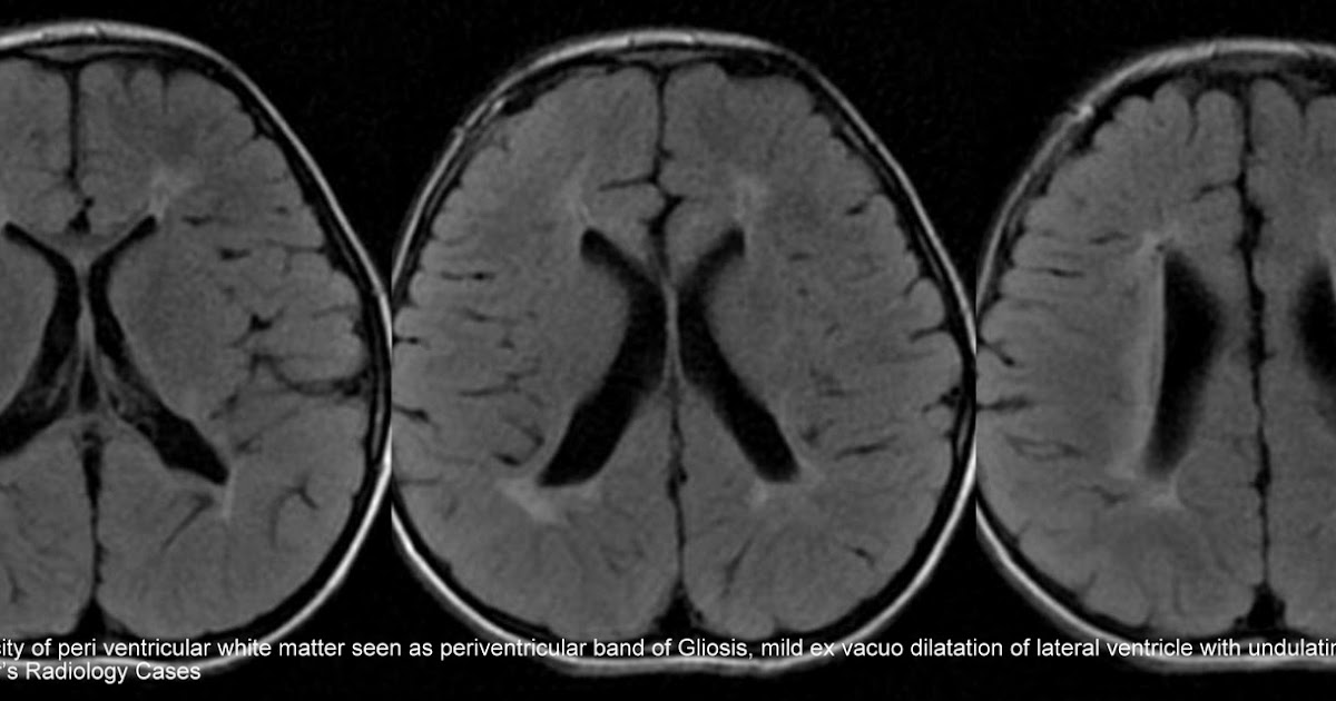 Neuroradiology Cases: Periventricular leukomalacia MRI