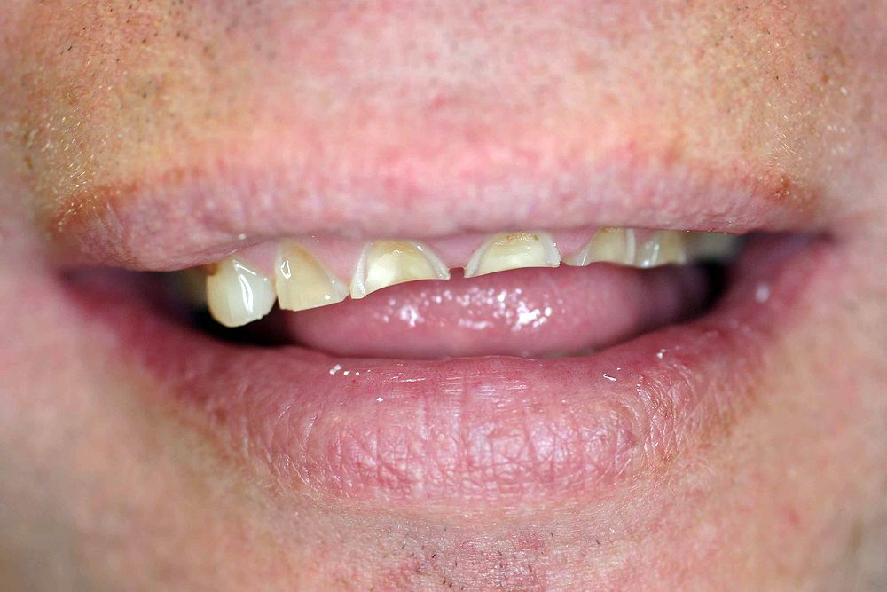 Bulimia’s Effect on your teeth | Directorio Odontológico