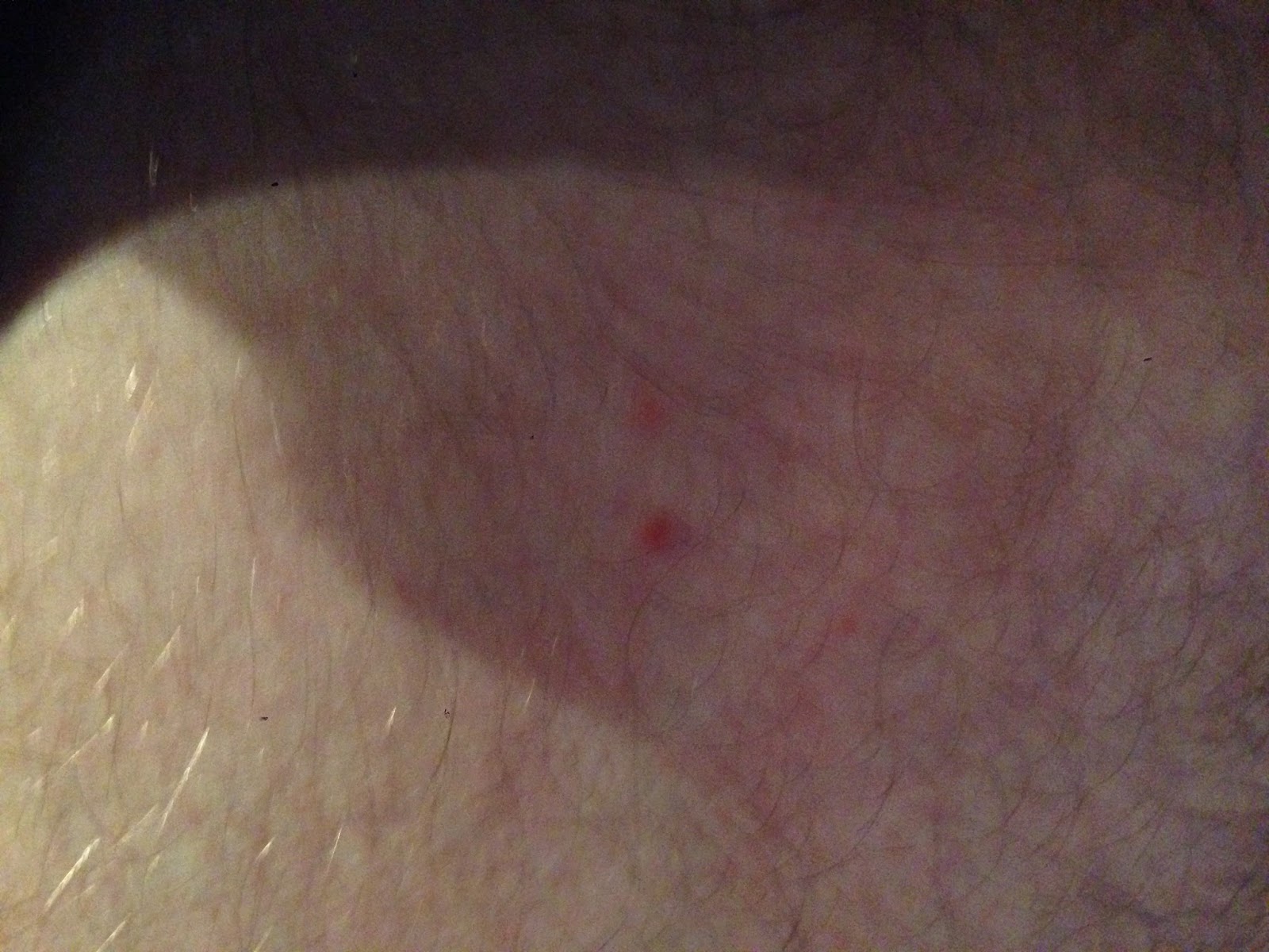 Scabies Treatment That Truly Works (My Personal Experience): Diagnosing ...