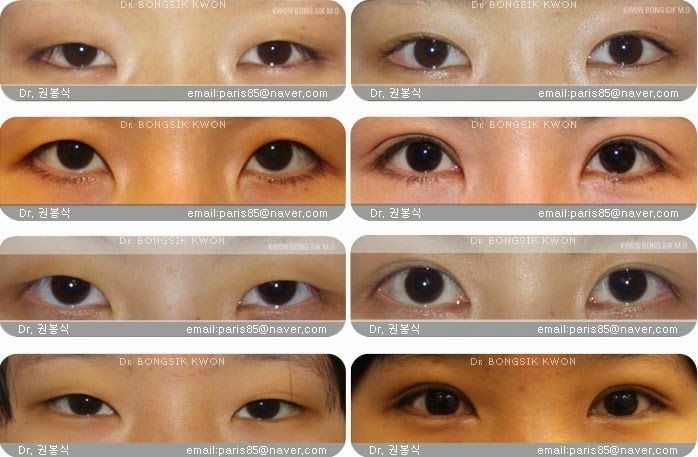 Teuim Aesthetic Plastic Surgical Clinic Dr.Kwon: What is non-incisional ...