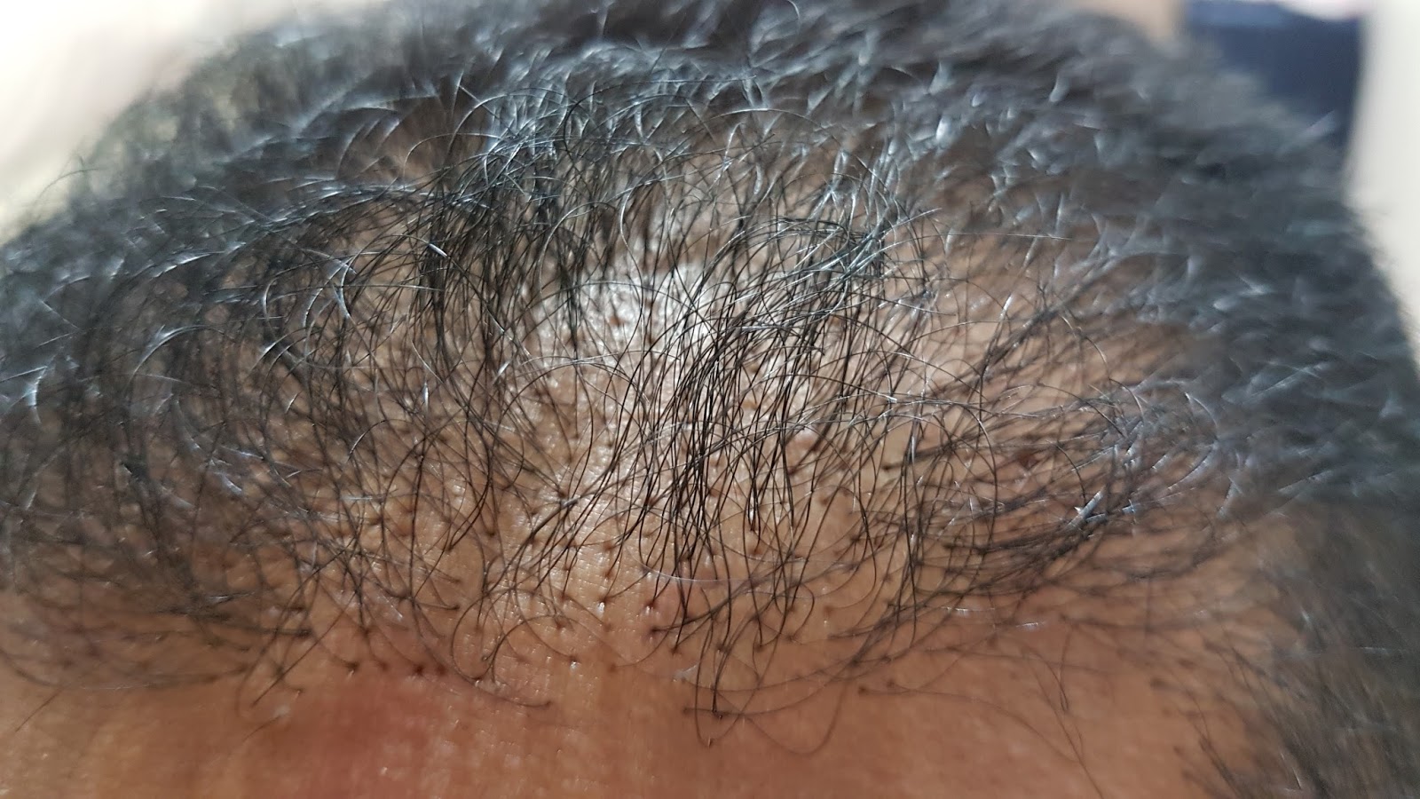 hair transplant experience - pengalaman transplantasi rambut / tanam ...