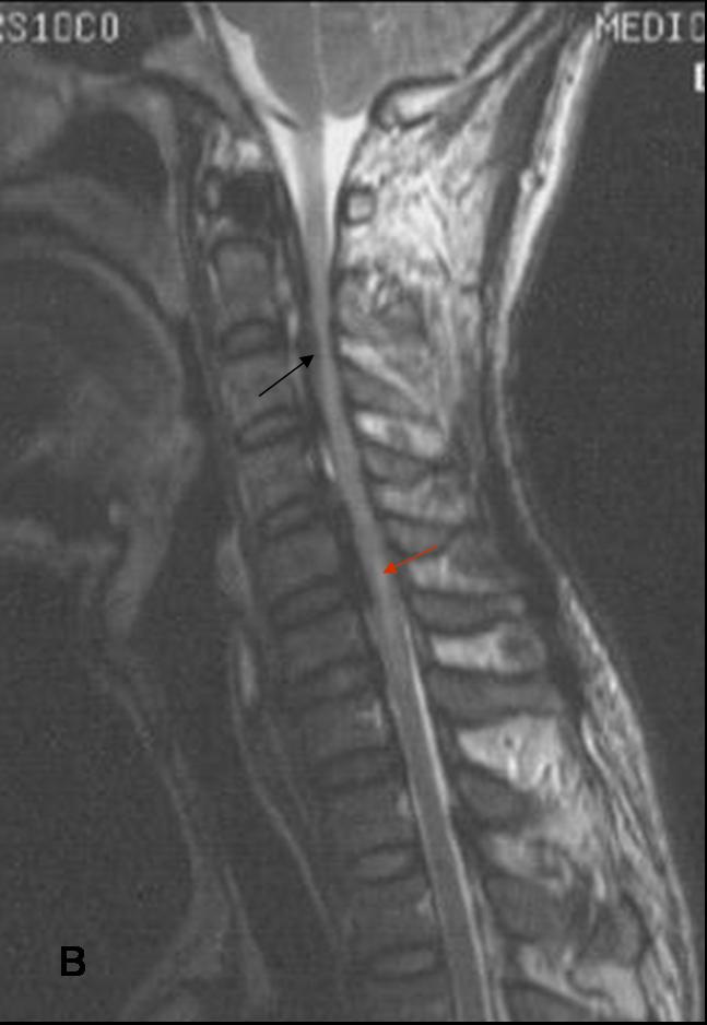 MRI MEDIC CASE STUDIES COLLECTION: Ossification of the posterior ...