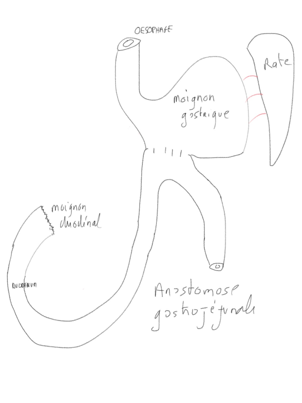 CHIRURGIE DIGESTIVE ET HEPATO-BILIAIRE: Gastrectomies (schémas explicatifs)