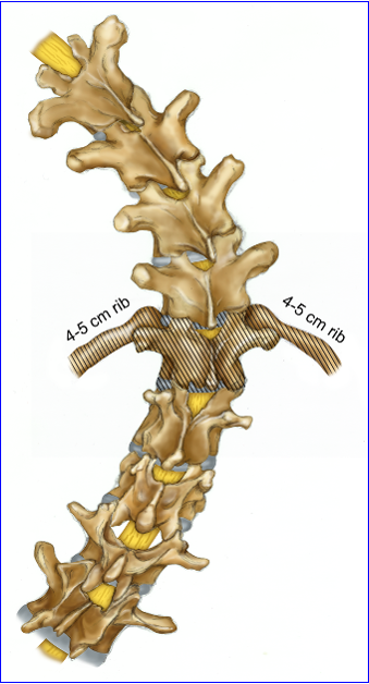 Vertebral Column Resection (VCR) in Pediatric Spinal Deformity Part 3 ...