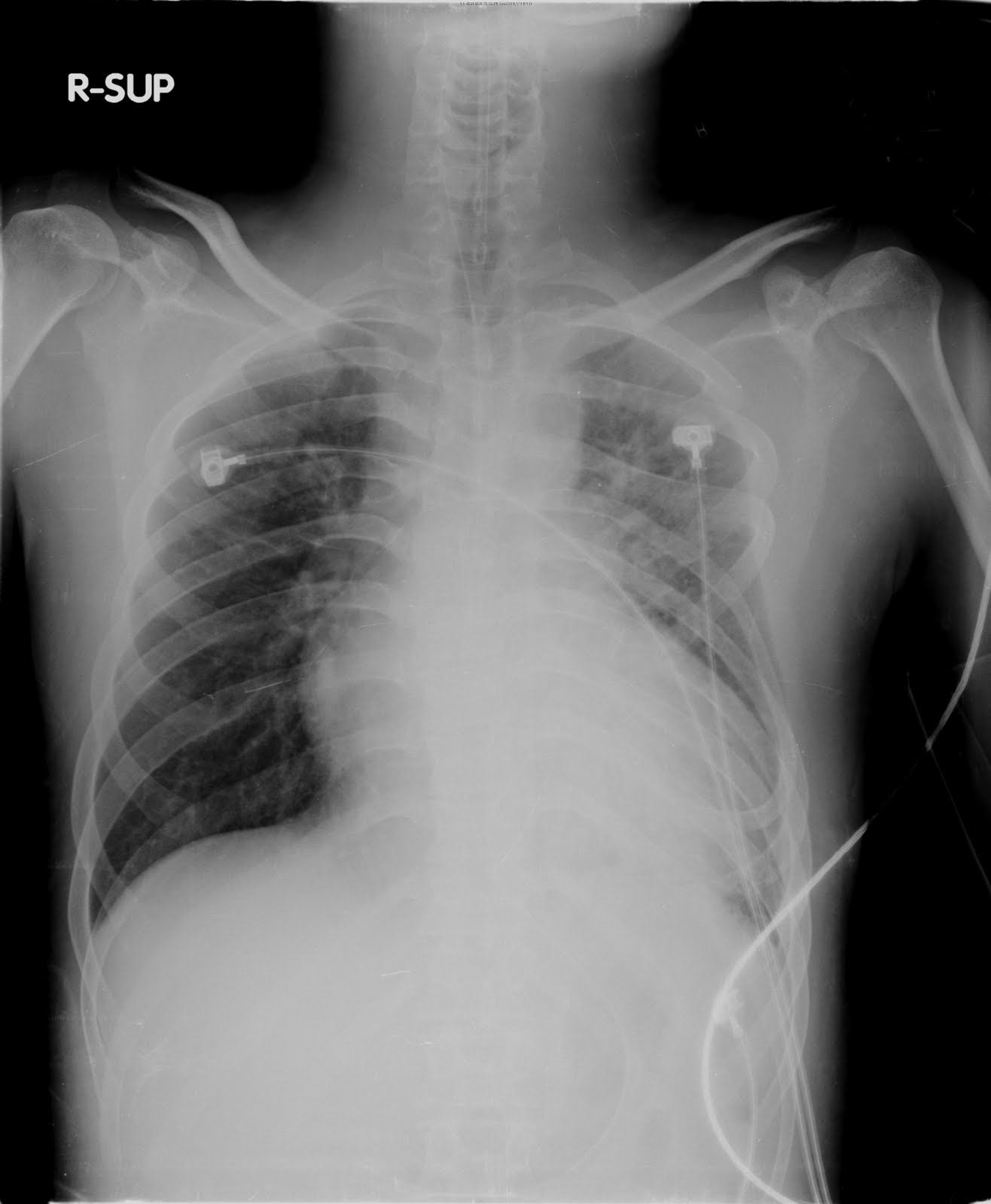 CXR 胸部x光判讀 Tetralogy of Fallot