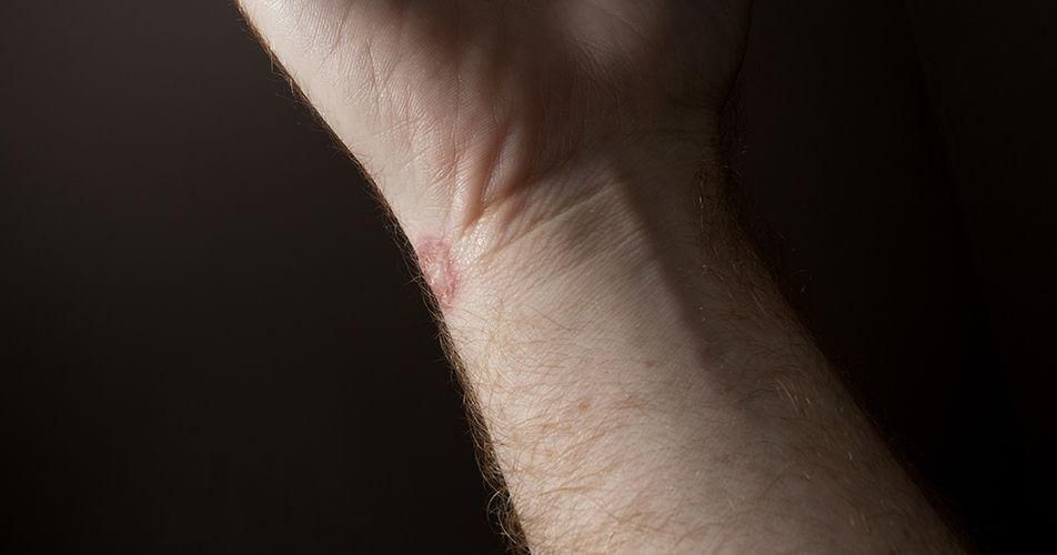 Ringworm: Characteristics, Causes and Prevention - Easy Heal