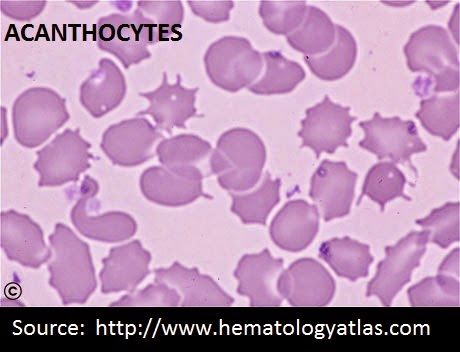 Lab Atlas: Acanthocytes
