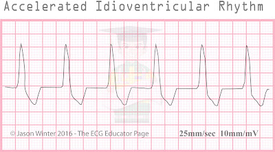ECG Educator Blog : Ventricular Rhythms