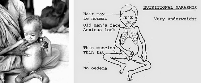 Public Health Indonesia: Protein Energy Malnutrition (PEM)