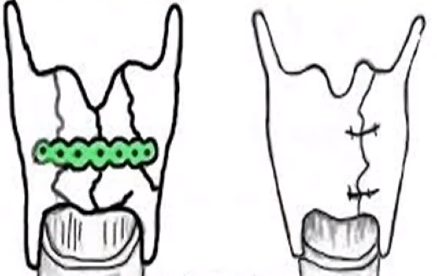 Laryngeal trauma: causes, types, symptoms, signs, treatment