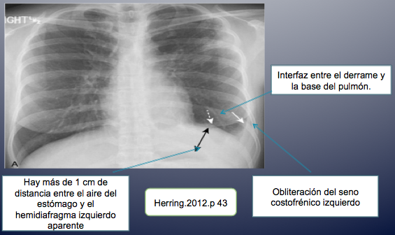 IDENTIFICACIÓN DE UN DERRAME PLEURAL: Derrame Subpulmonar Izquierdo