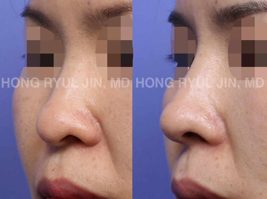 Rib cartilage rhinoplasty