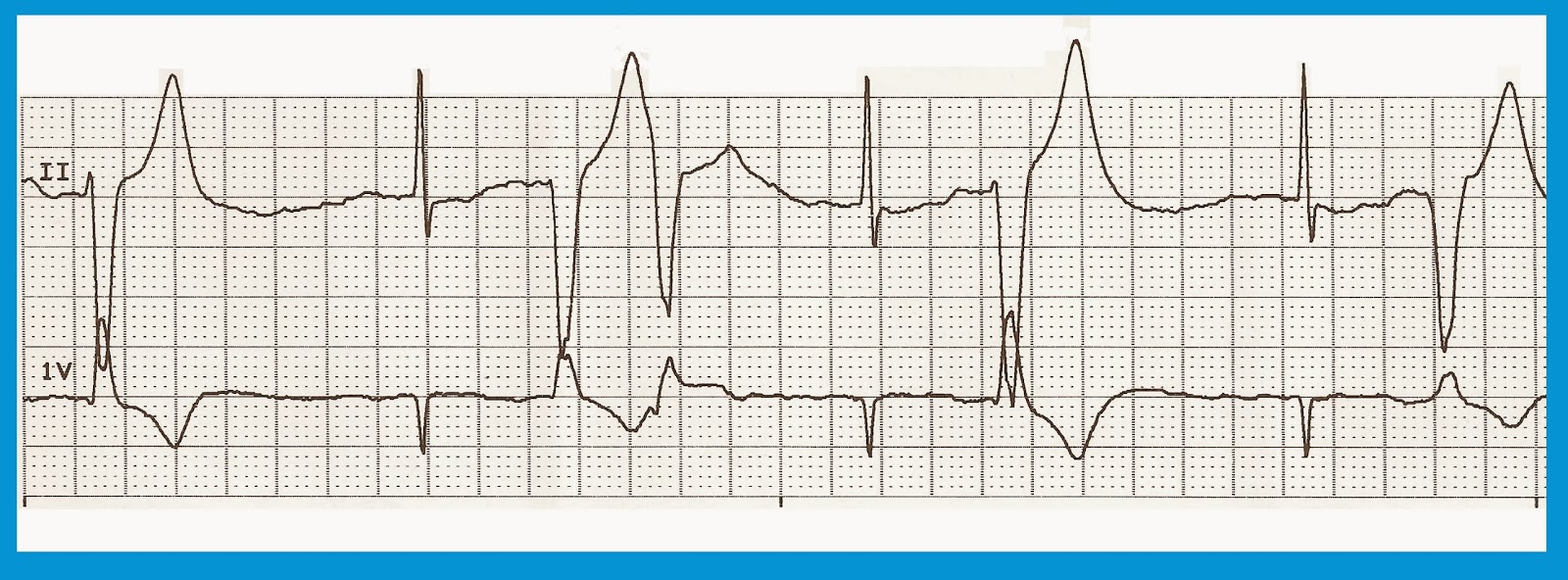 EKG Rhythm Strip Quiz 205