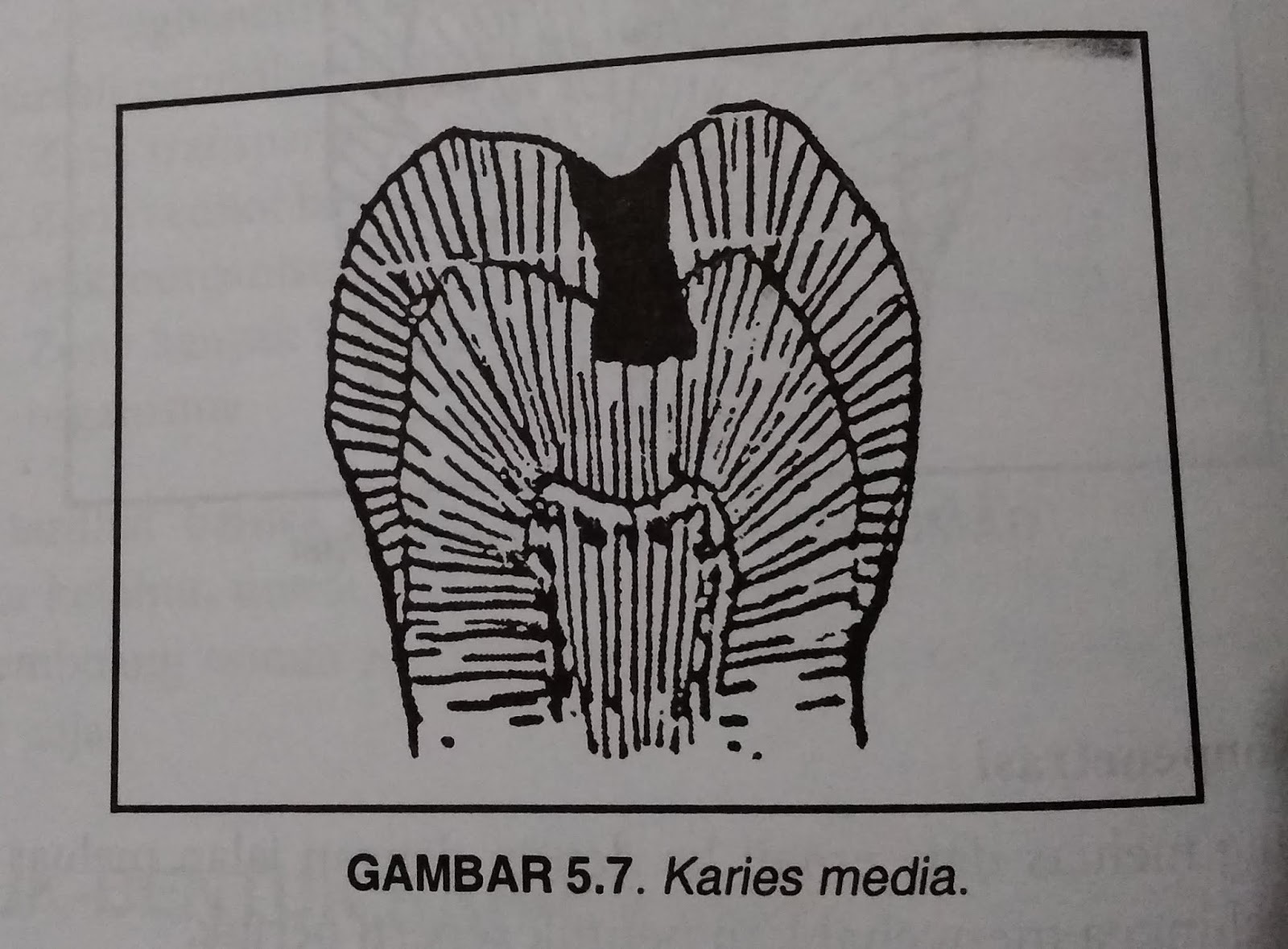 Karies Gigi Berdasarkan Stadium Karies dan Cara Meluasnya