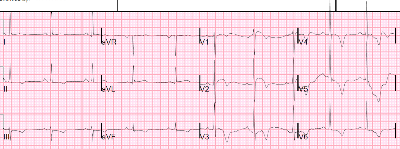 Dr. Smith's ECG Blog: Do you recognize these ECGs? STEMI? LVH? What?