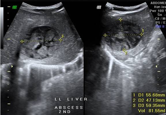 LIVER ABSCESS WITH HEPATO PLEURAL FISTULA - Sumer's Radiology Blog