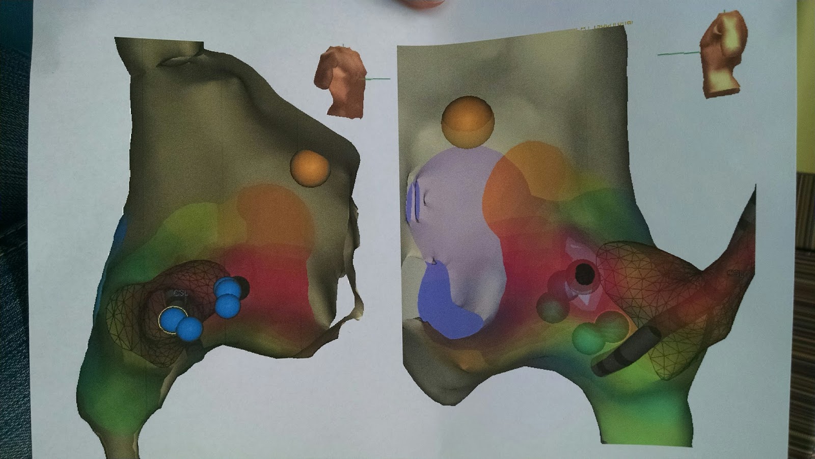 The Story of a Baby with SVT(PJRT)