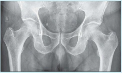 Creación de protocolos. MMSS, MMII, Cadera y Pelvis: cadera