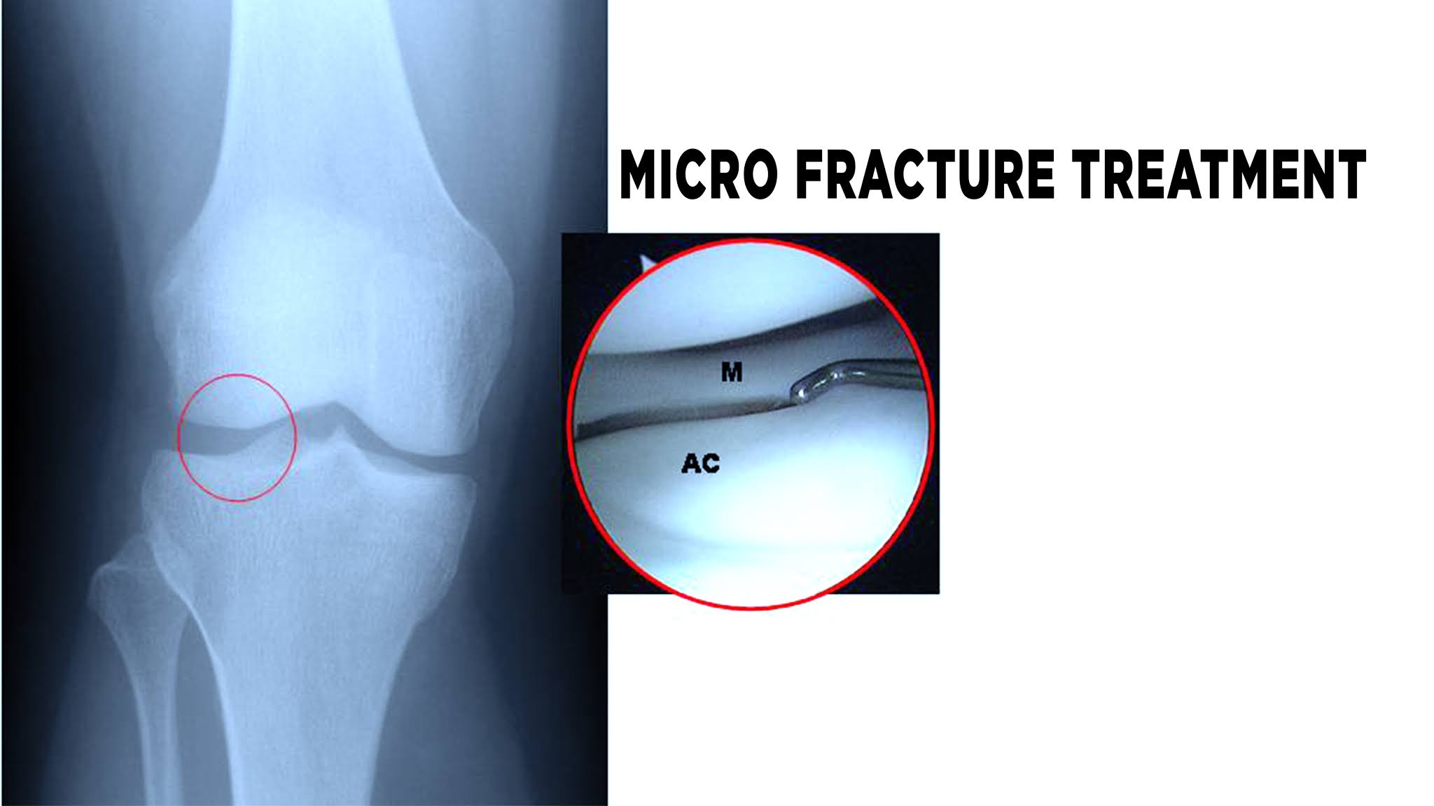 Micro Fracture Treatment | Micro Bone Fracture Surgery