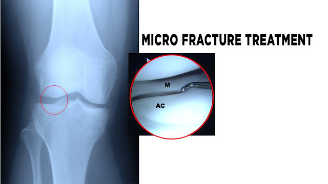 Micro Fracture Treatment | Micro Bone Fracture Surgery