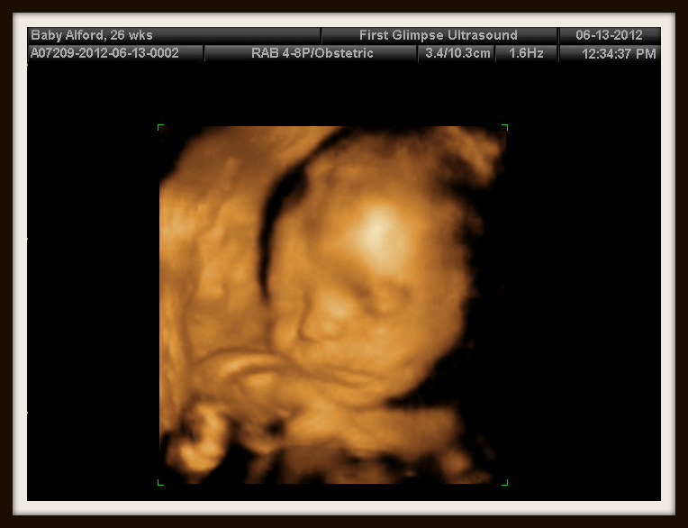 Us + Two: 25 Weeks 6 Days- 3D Ultrasound